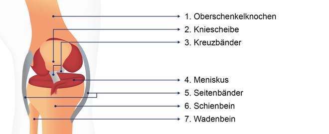 Kniearthrose: Überblick | Arthrose