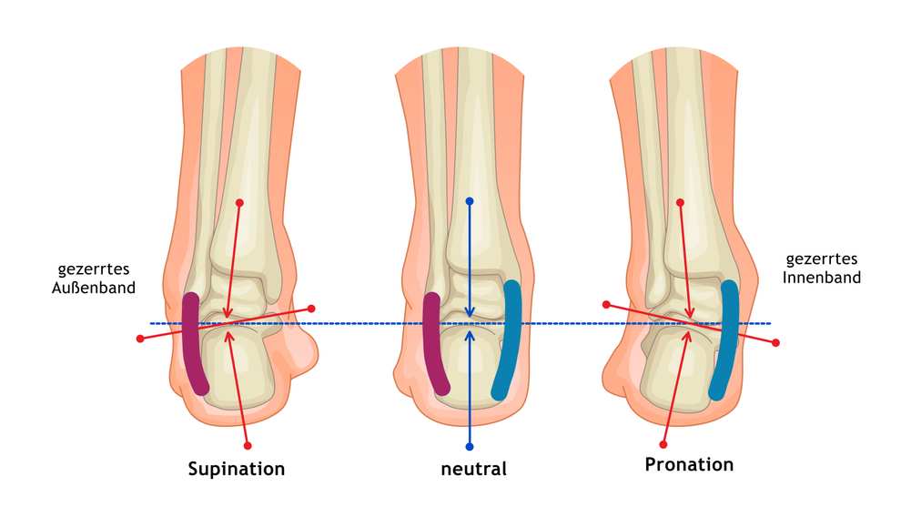 Bänderriss: Ursachen | Bänderverletzungen