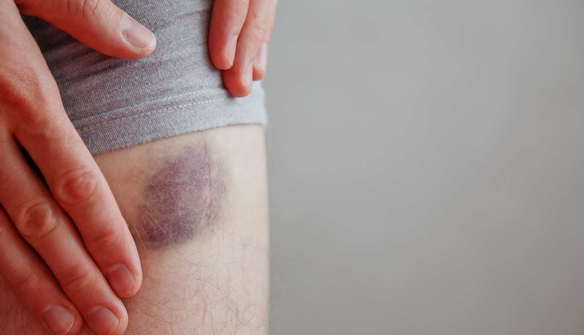 Oberschenkel-Prellung | Prellung