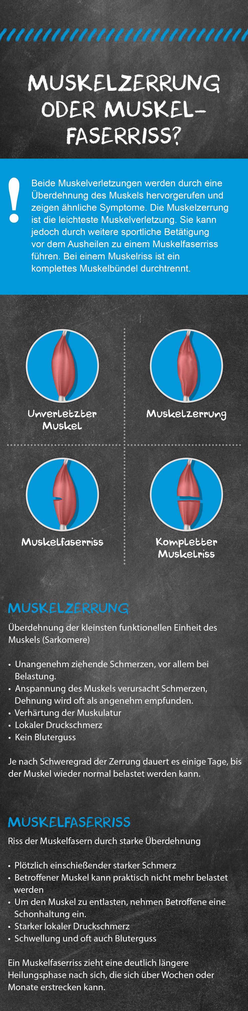 zerrungen-infografik | Zerrungen